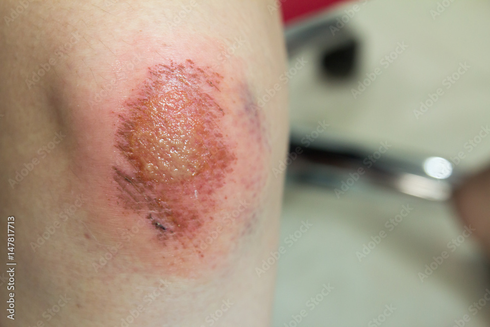Fresh wound with lymph and blood on asian female knee background Stock ...