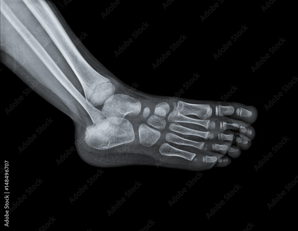 X ray of foot showing ankle joint. Stock Photo | Adobe Stock