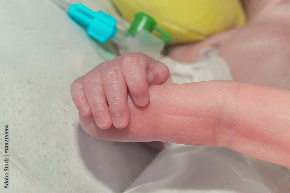Hand of premature newborn baby with pleural cavity drainage hold her ...
