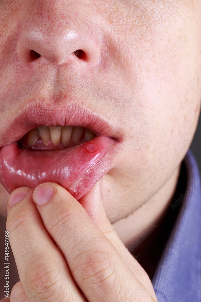 Stomatitis Lips