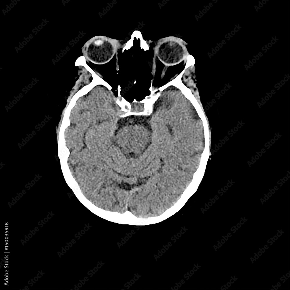 Head CT scan of an 85 year old female patient with signs of dementia ...