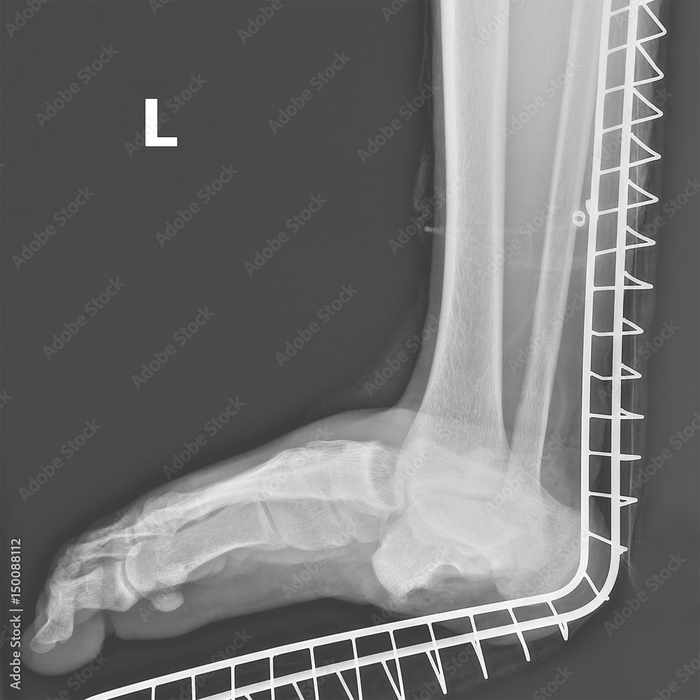 X-ray image of joint dislocation left foot. Stock Photo | Adobe Stock
