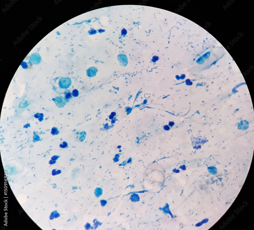 Smear of Acid-Fast bacilli (AFB) stained from sputum specimen, under ...