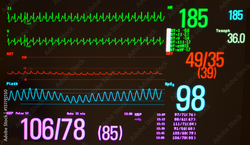 Monitor showing atrioventricular nodal reentrant tachycardia or AVNRT ...