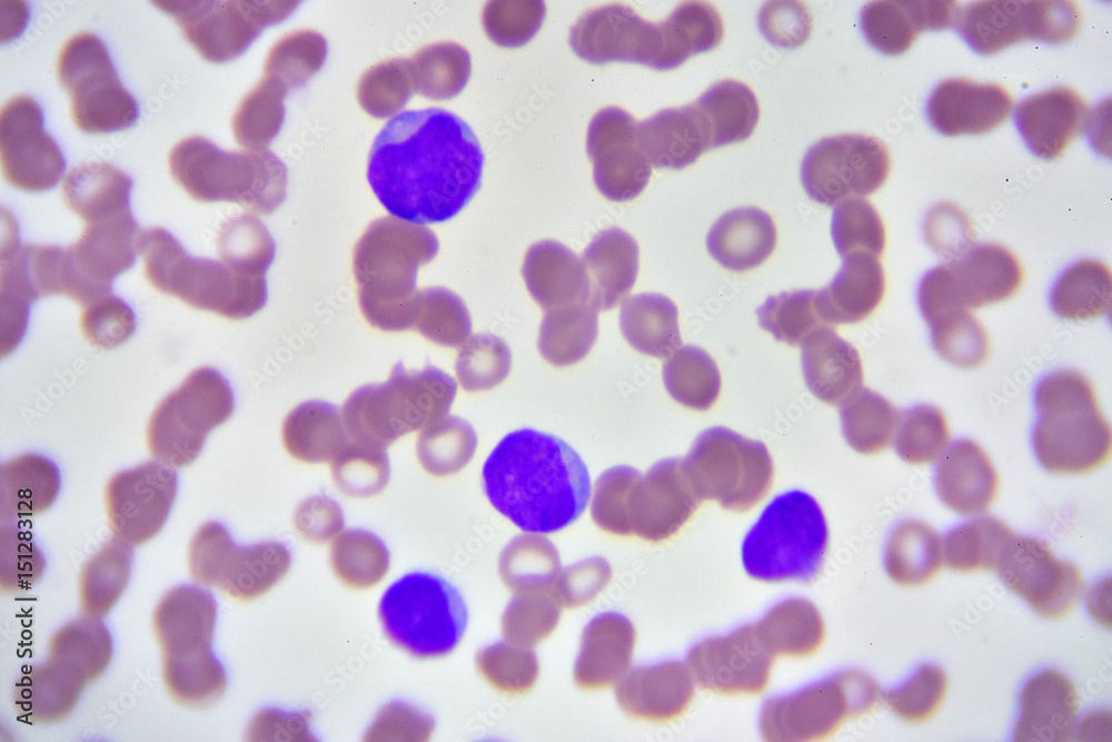 Leukemia cells in blood smear, analyze by microscope foto de Stock ...