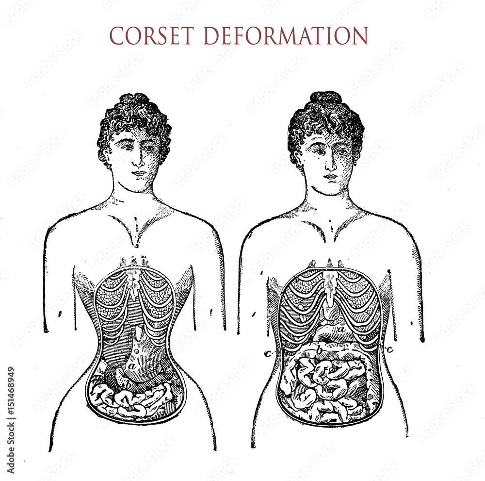 Vintage fashion lifestyle, corset usage and unhealthy deformation Stock ...