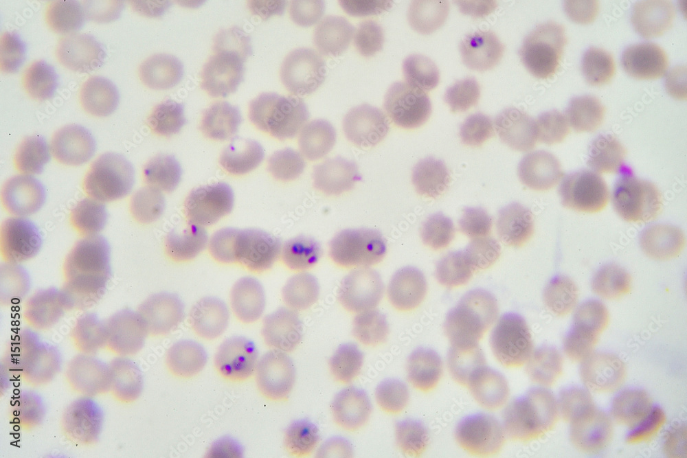 Red blood cells infected with malaria parasite (Plasmodium falciparum ...