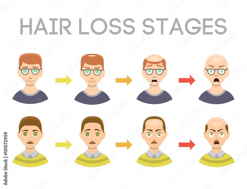 Information chart of hair loss stages types of baldness illustrated on ...