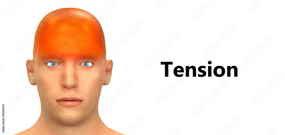 Human Headache Types of Anatomy (Tension) Stock Illustration | Adobe Stock