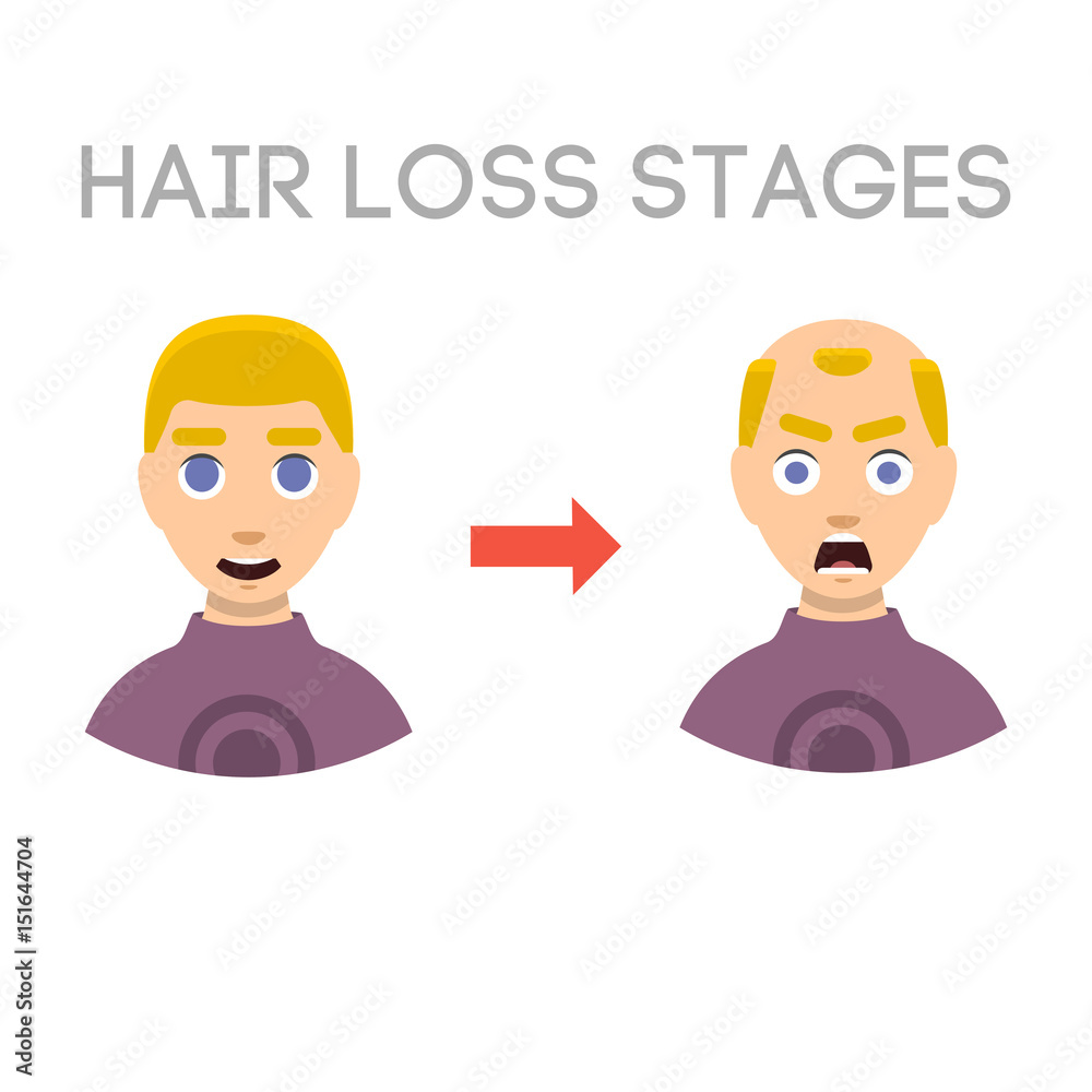 Information chart of hair loss stages types of baldness illustrated on ...
