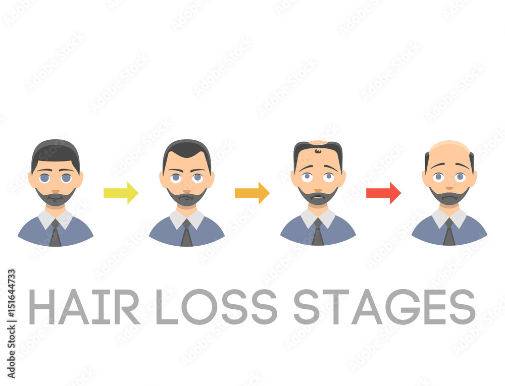 Information chart of hair loss stages types of baldness illustrated on ...
