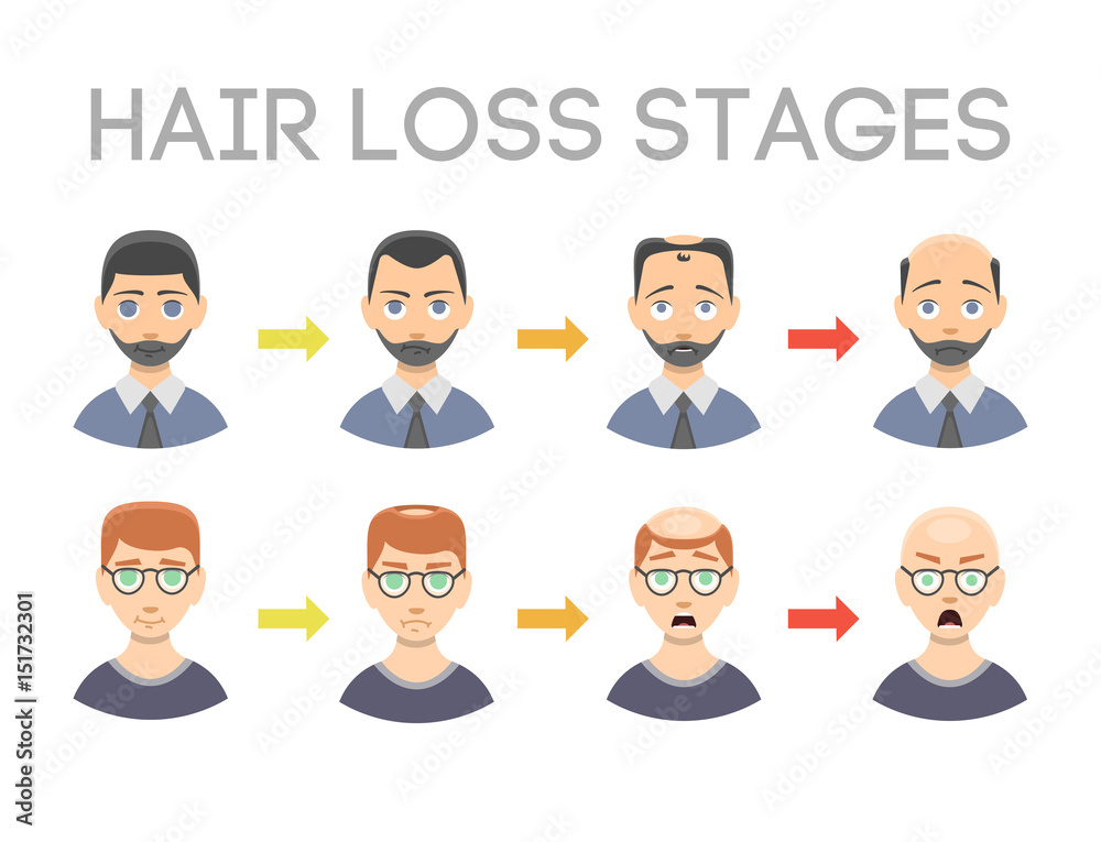 Information chart of hair loss stages types of baldness illustrated on ...