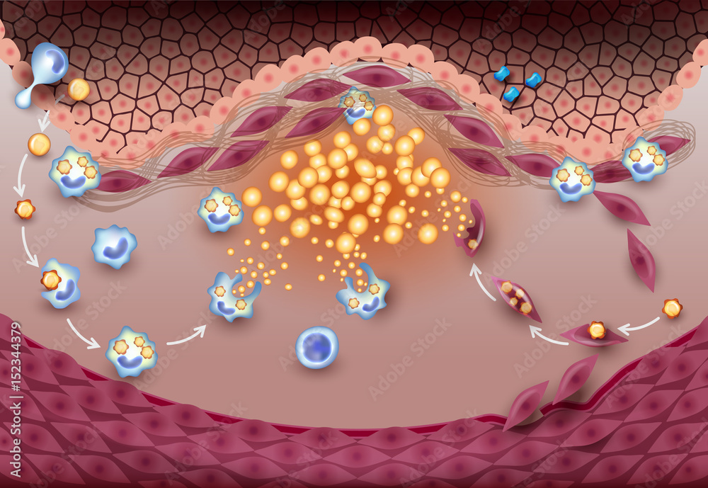 Stable atherosclerotic plaque formation in the human artery, they tend ...