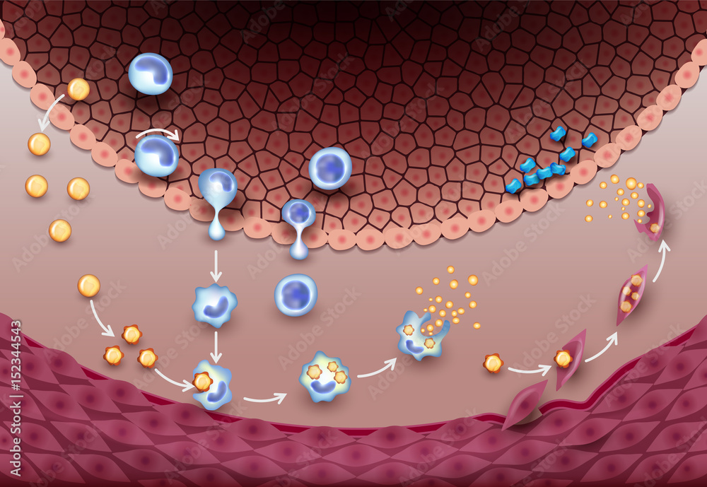 First signs of atherosclerosis, very early stage. Fatty streak ...