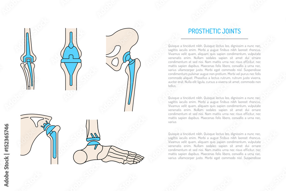 Medical illustration of the implantation of the bone joints in the ...