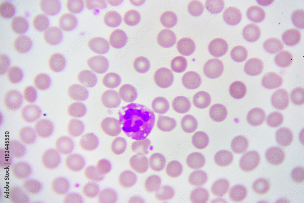 Neutrophil cell (white blood cell) in blood smear, analyze by ...