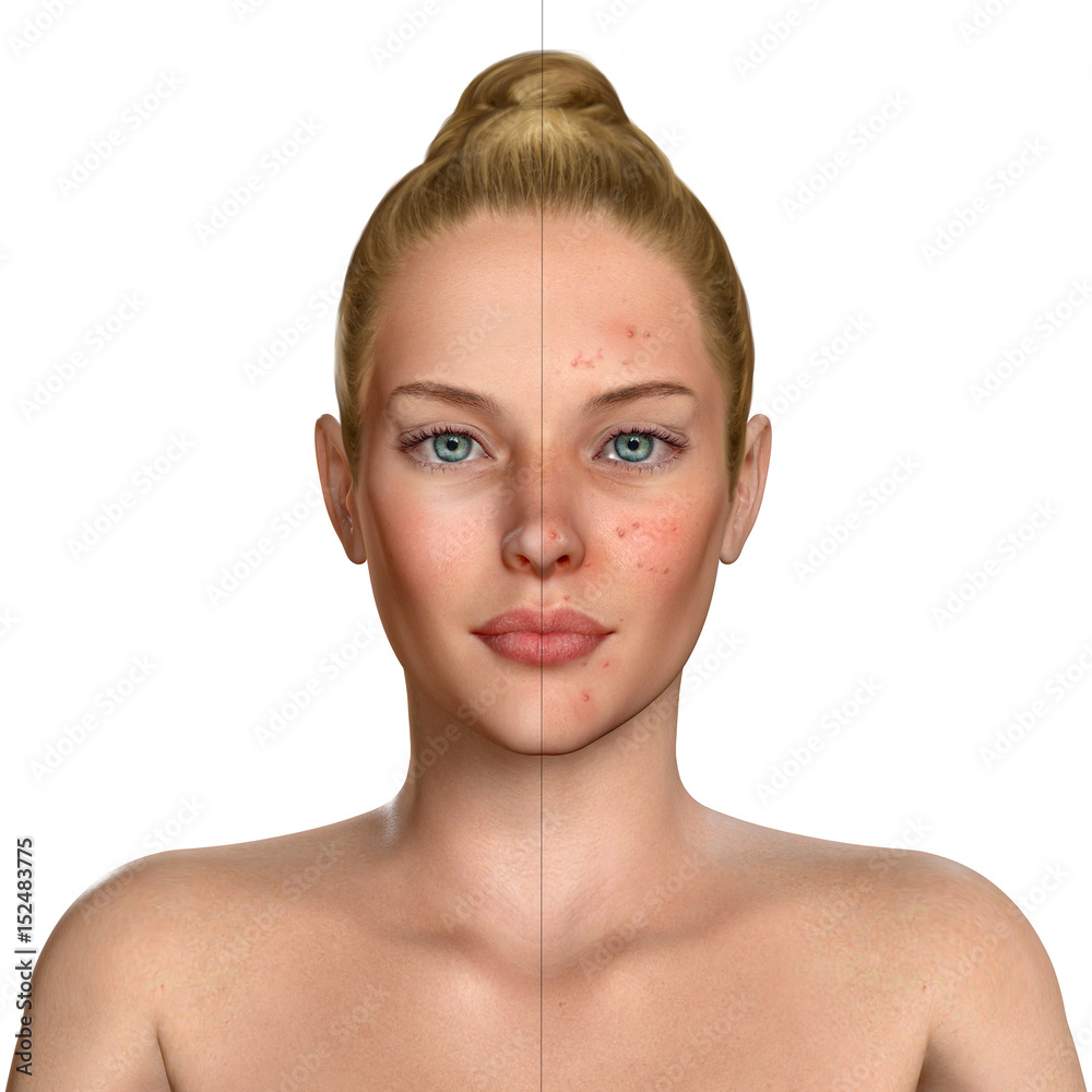 3d illustration of a woman before and after acne treatment procedure ...