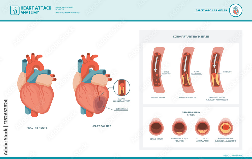 Anatomy of a heart attack Stock Vector | Adobe Stock
