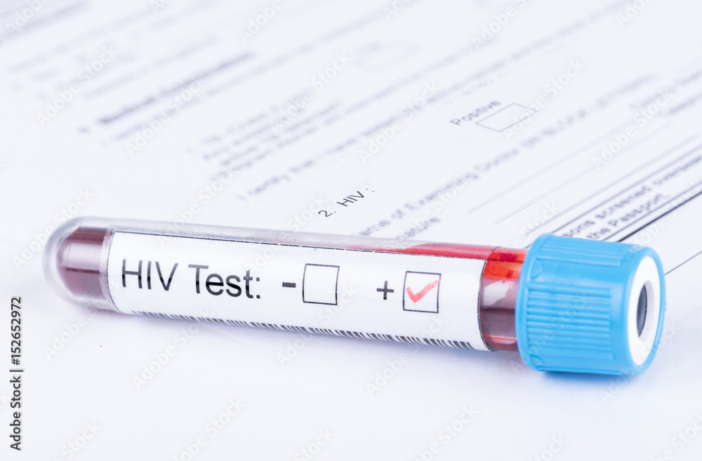 HIV positive test sample with medical forms Stock Photo | Adobe Stock