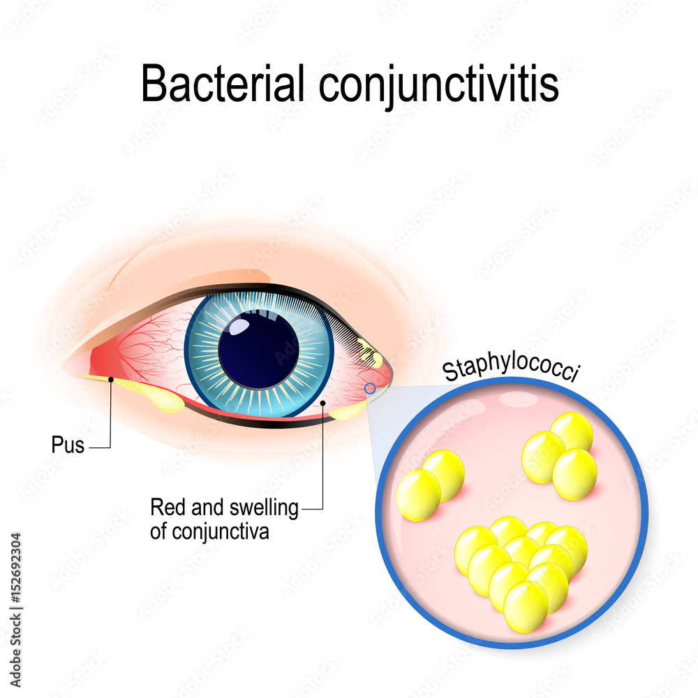 Bacterial Conjunctivitis