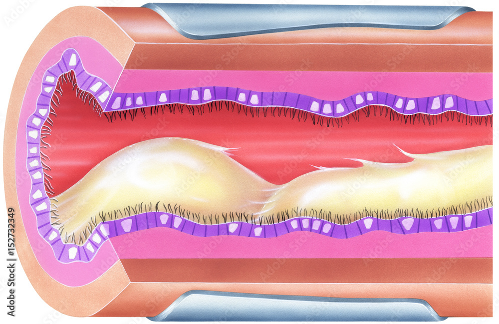 Bronchial airway obstruction and narrowing due to viscid mucus ...
