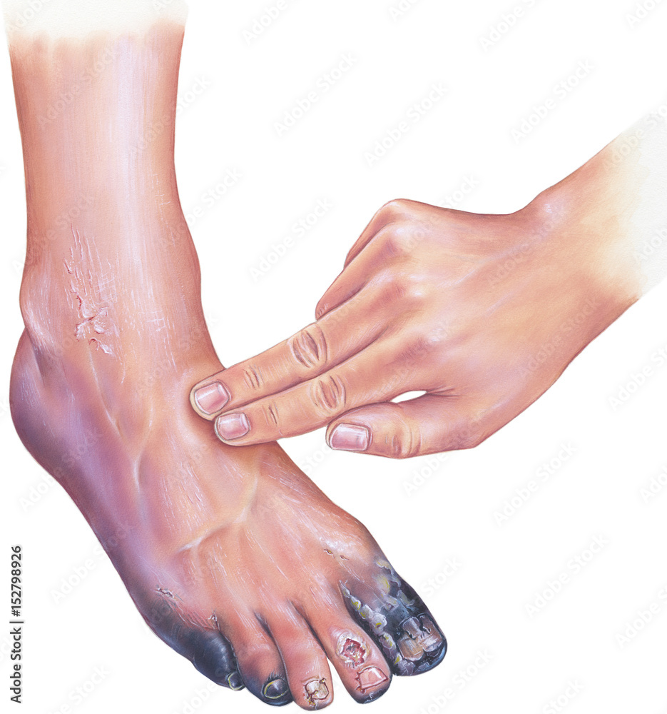 Diabetic arterial disease, showing gangrene and ulcerations of the toes ...