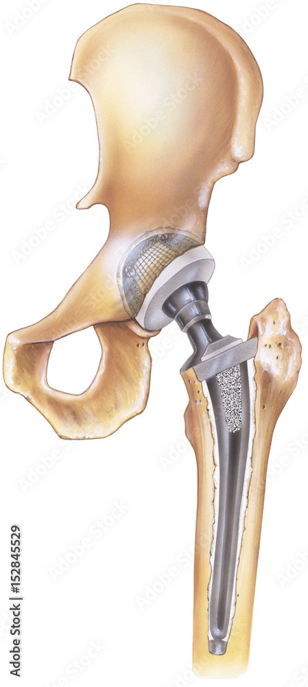 illustration of a total hip replacement. The femoral stem and the ...