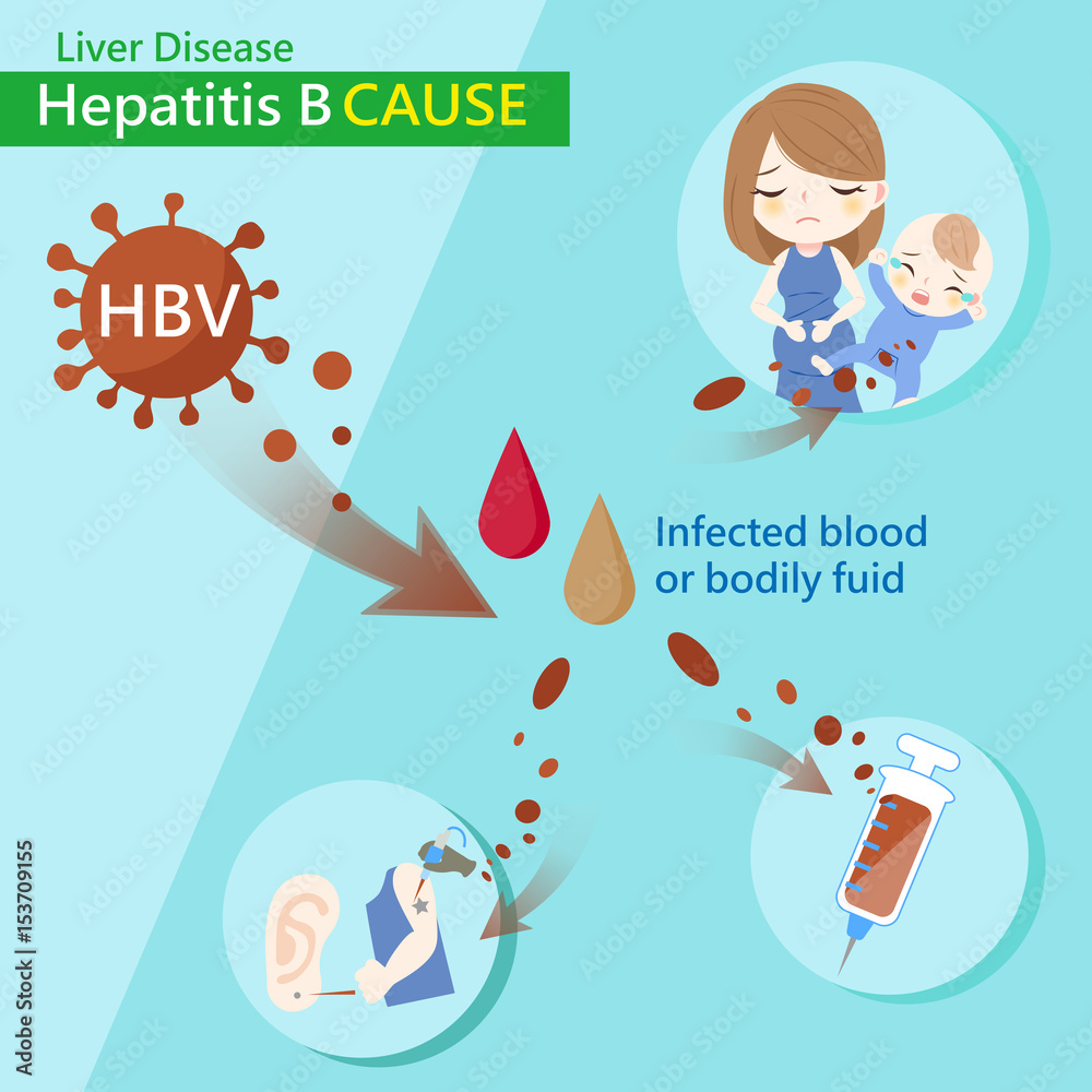 hepatitis b cause Stock Vector | Adobe Stock