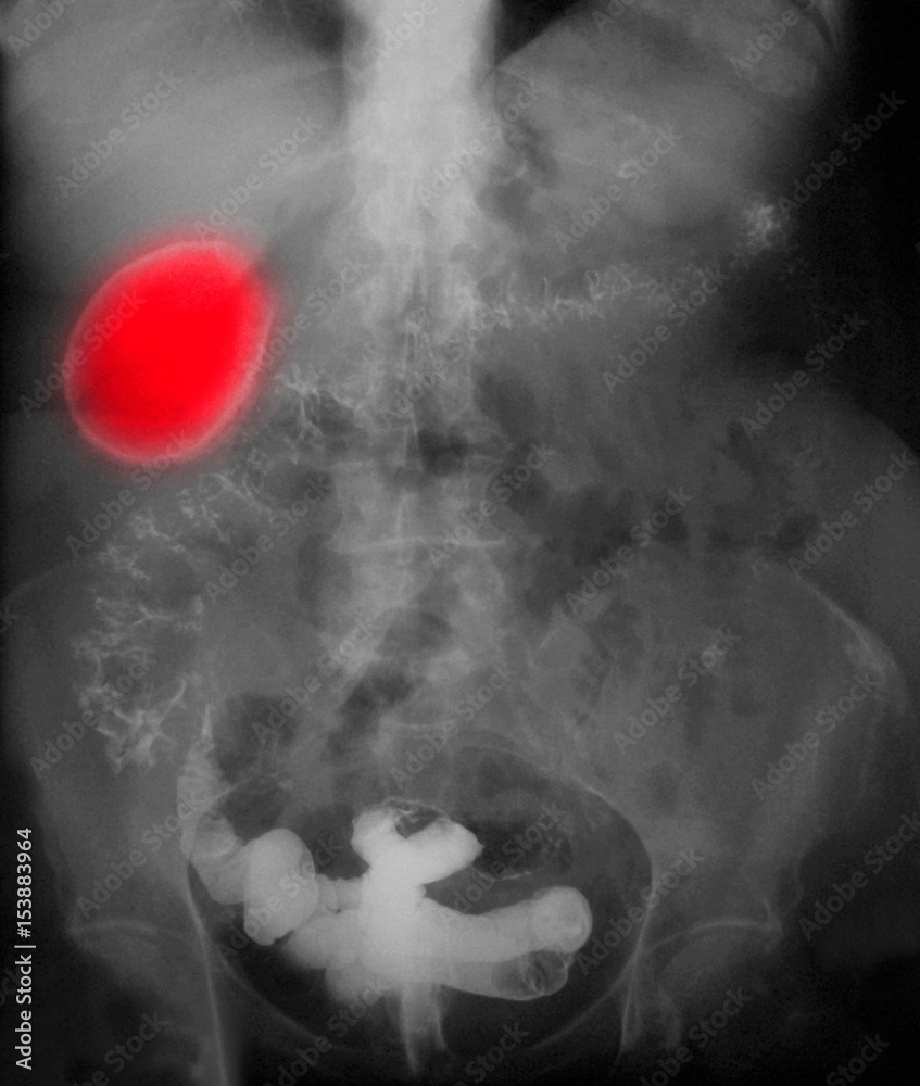 X-ray showing a so-called porcelain gallbladder Stock Photo | Adobe Stock
