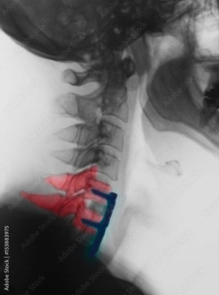 Cervical xray showing spinal fusion, C5, C6, C7 Stock Photo | Adobe Stock