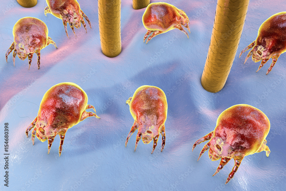 Dust mites Dermatophagoides on human skin with hairs, parasites which ...