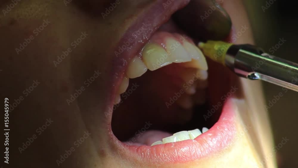 Dentist giving anesthesia to the patient. Injection - syringe and ...