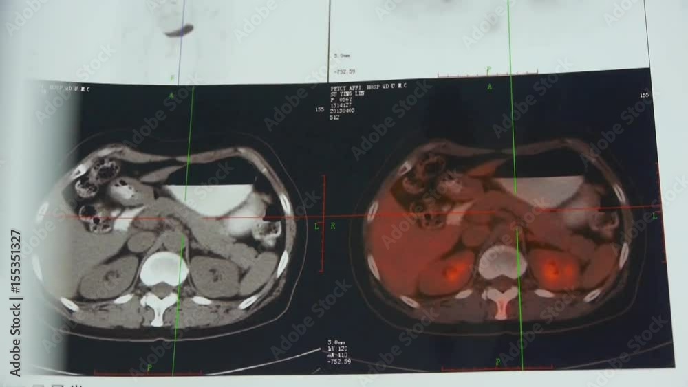 doctor study color stomach & pancreas pet-ct scan,human organ ...
