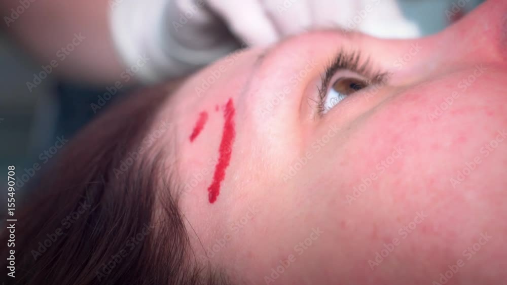 4K Woman Forehead Bleeding after PDO Thread Implants Stock-Video ...