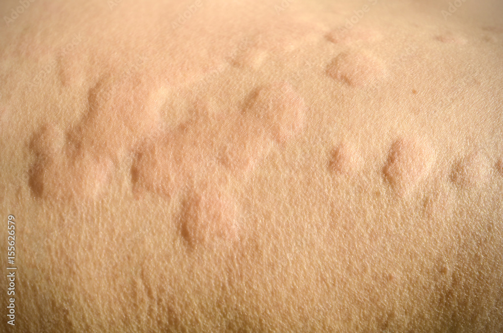Skin rash, Urticaria, Allergic skin reaction. Stock Photo | Adobe Stock