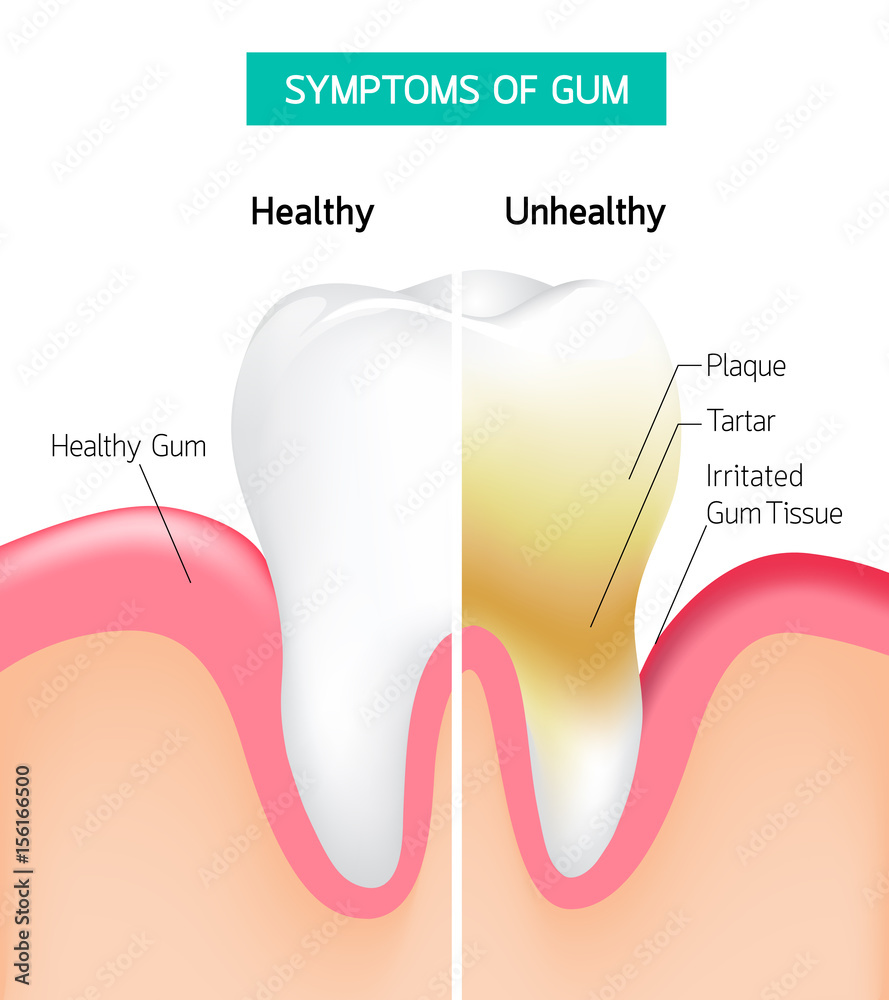 Dental problem health care. Comparison of Healthy and unhealthy tooth ...