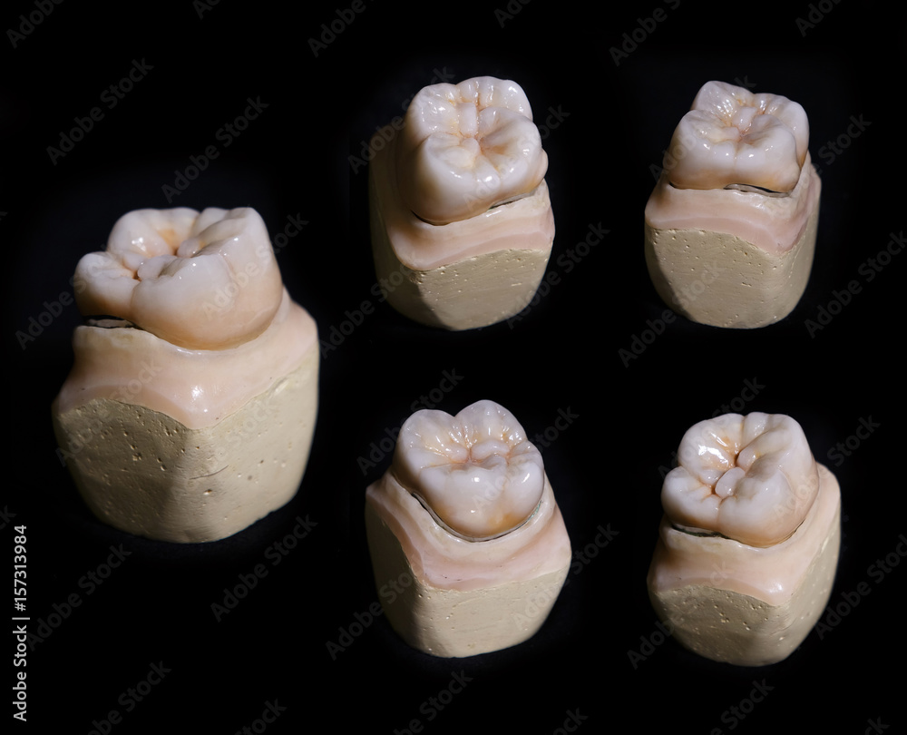 Ceramic teeth dental crowns on model, metal free - front view . Ceramic ...