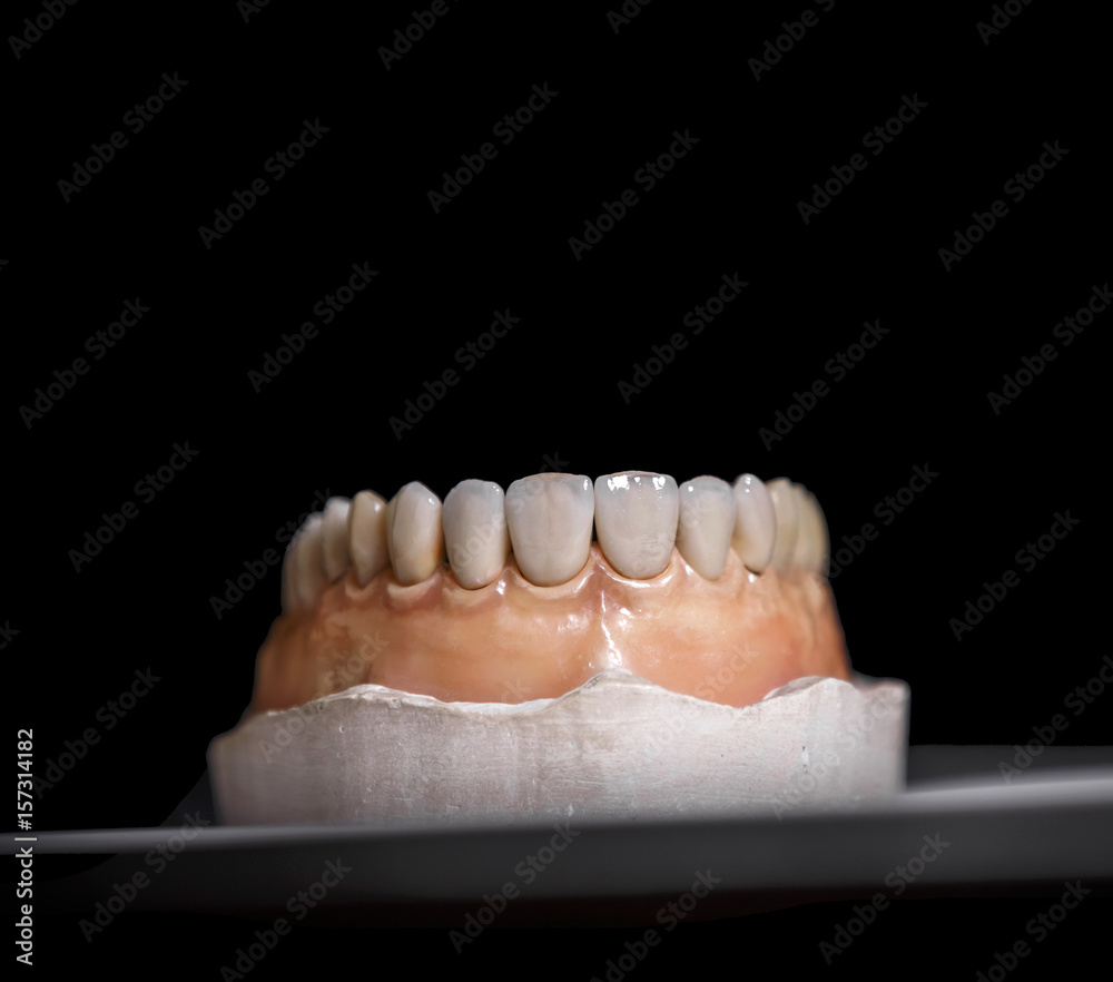 Ceramic teeth dental crowns on model, metal free - front view . Ceramic ...