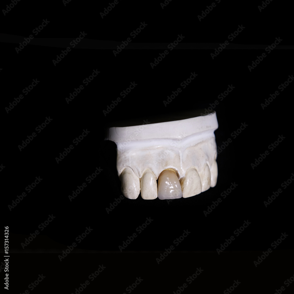 Ceramic teeth dental crowns on model, metal free - front view . Ceramic ...