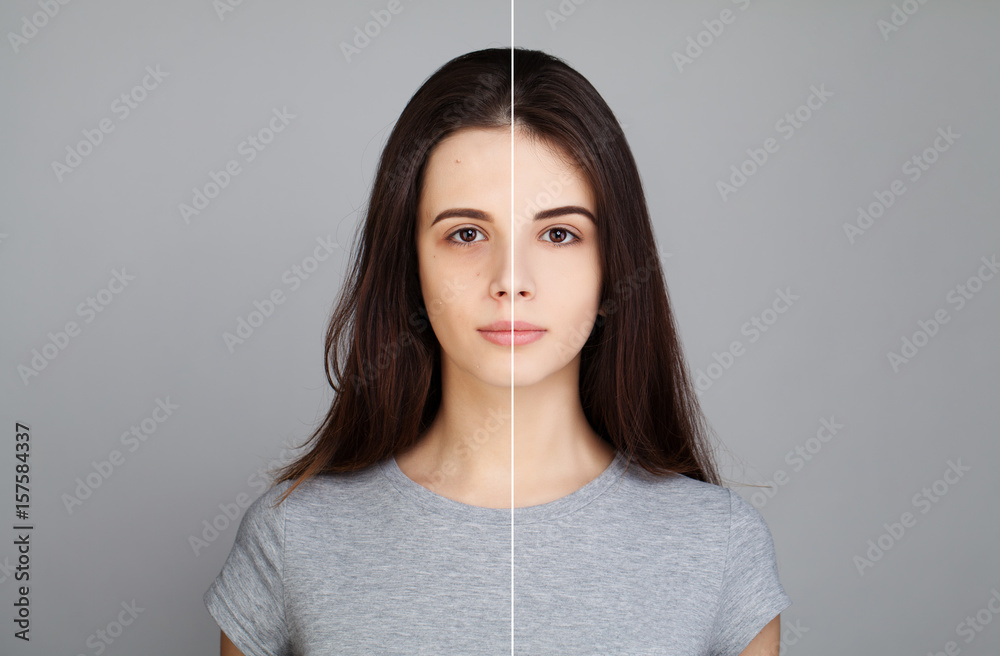 Young Model Woman with Skin Problem. Female Face, Healthy and Unhealthy ...