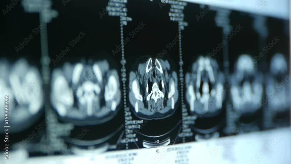 human subclavian pet-ct scan,lymph nodes X-ray,Cancer metastasis. Stock ...