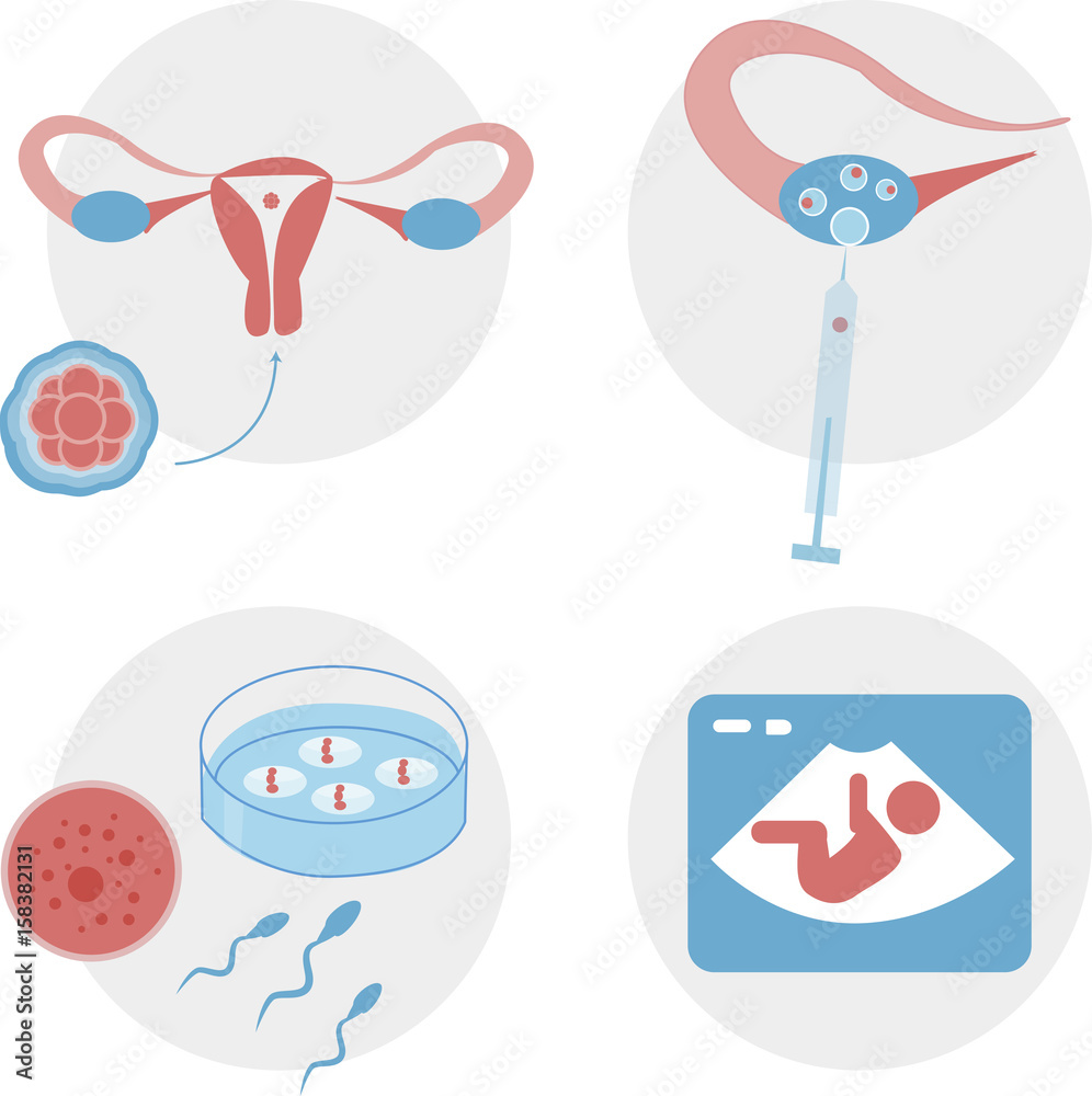 Pregnancy in vitro. Infographics. In Vitro Fertilization: IVF. Set of ...