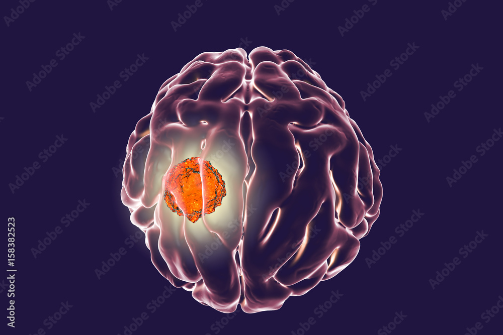 Brain cancer, 3D illustration showing presence of tumor inside brain ...