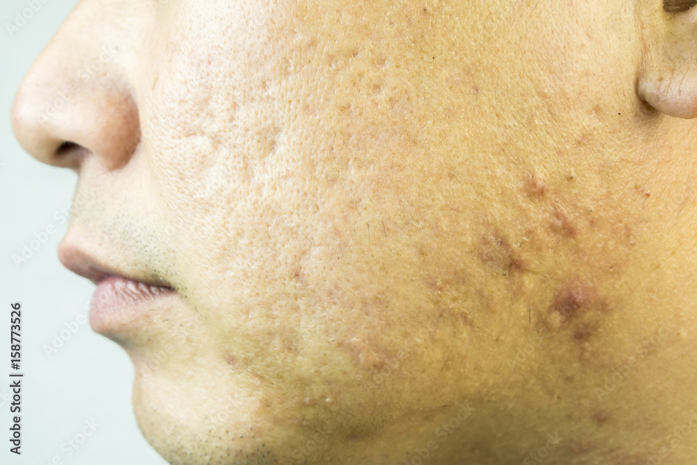 Severe Acne Scars On Cheeks