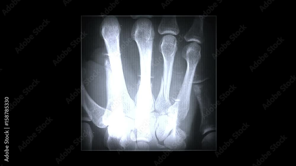 4k Human rib finger bones scan,tech medical X-ray scanning,X-ray ...