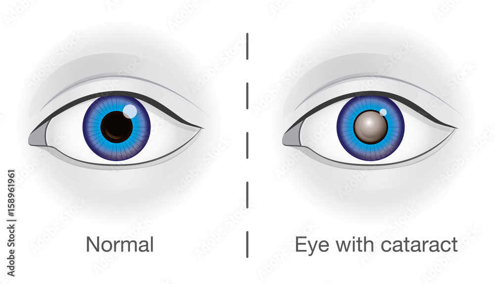 Normal eye and lens clouded by cataract. Illustration about health and ...