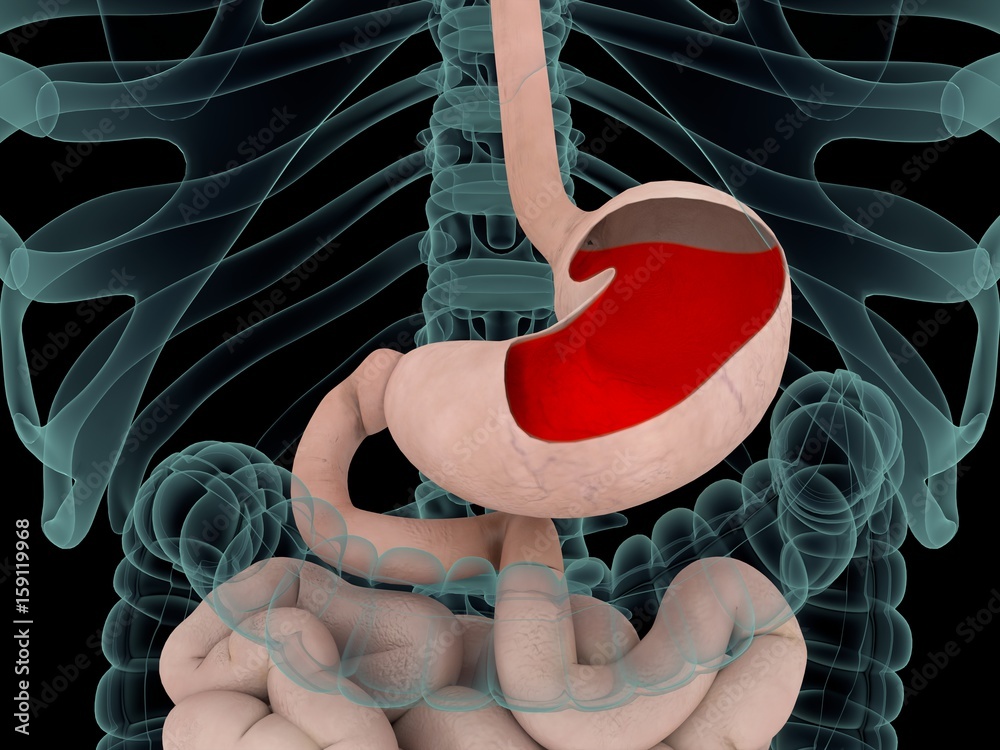 Acid reflux, GERD. Gastroesophageal reflux disease. Stomach and ...