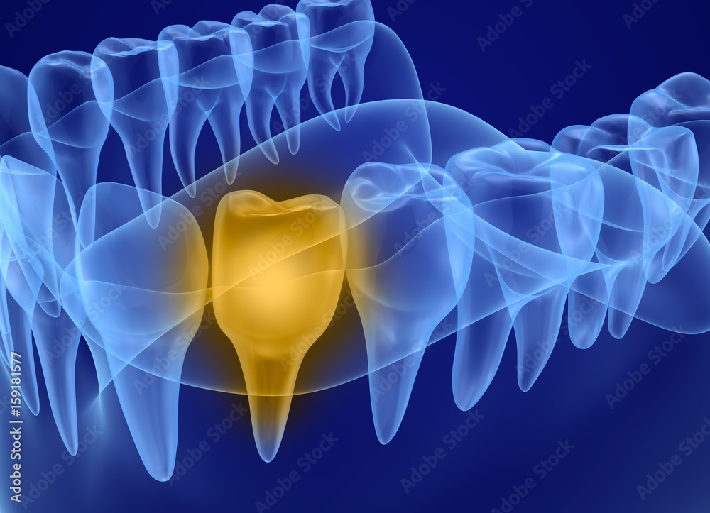 Problem teeth xray view. Medically accurate tooth 3D illustration Stock ...