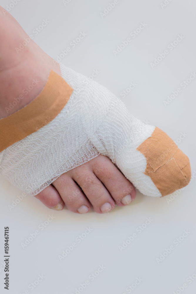Zeh Operation am großen Zeh Stock Photo | Adobe Stock