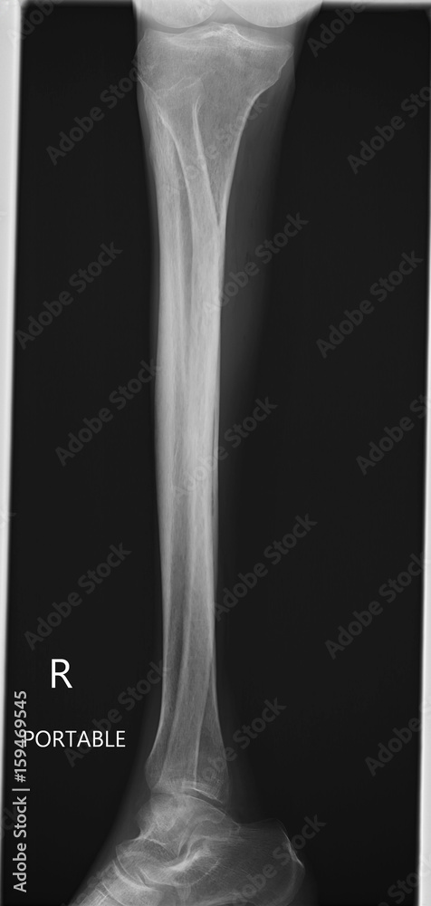 X-ray of human leg lateral view Stock Photo | Adobe Stock